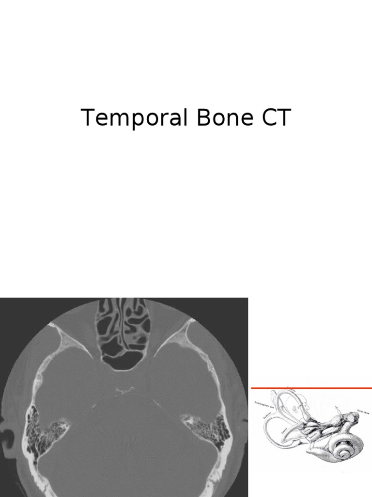 Ct Anatomy Of Temporal Bone Temporal Bone Radiology | SpringerLink