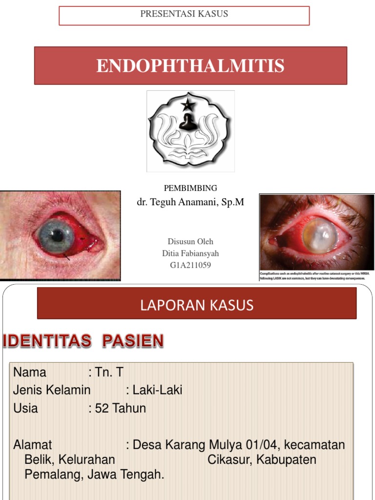 ENDOPHTHALMITIS | PDF