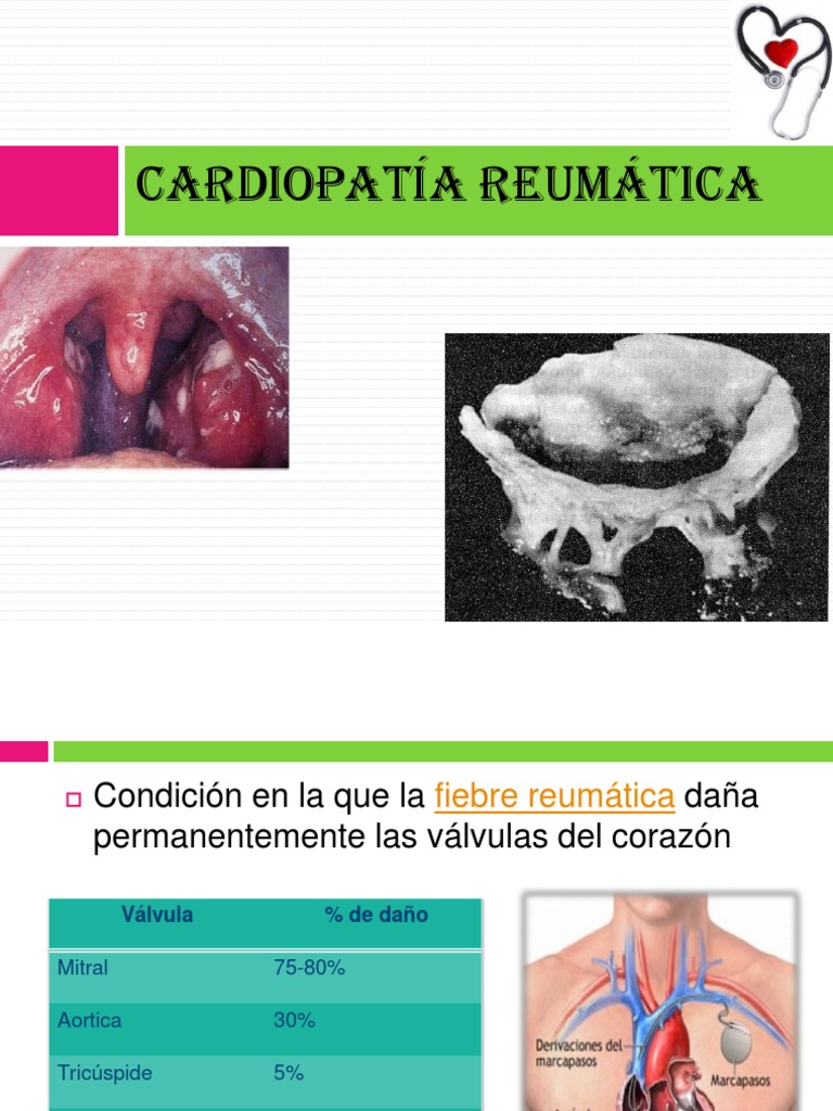Cardiopatia Reumatica | PDF | Enfermedades cardiovasculares | Rtt