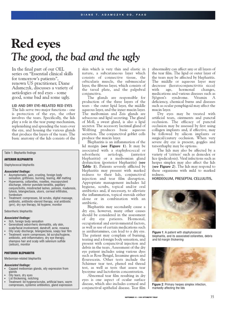 Red Eyes | PDF | Ophthalmology | Medicine