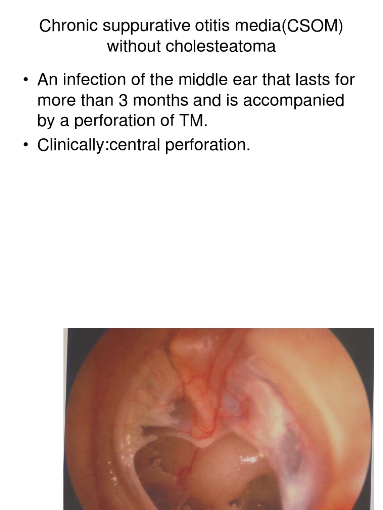 Chronic Suppurative Otitis Media With Cholesteatoma