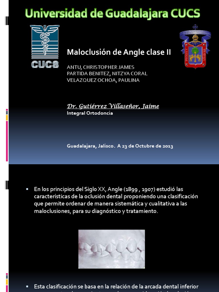 Maloclusión Clase II en Ortodoncia | PDF | Diente humano | Diente