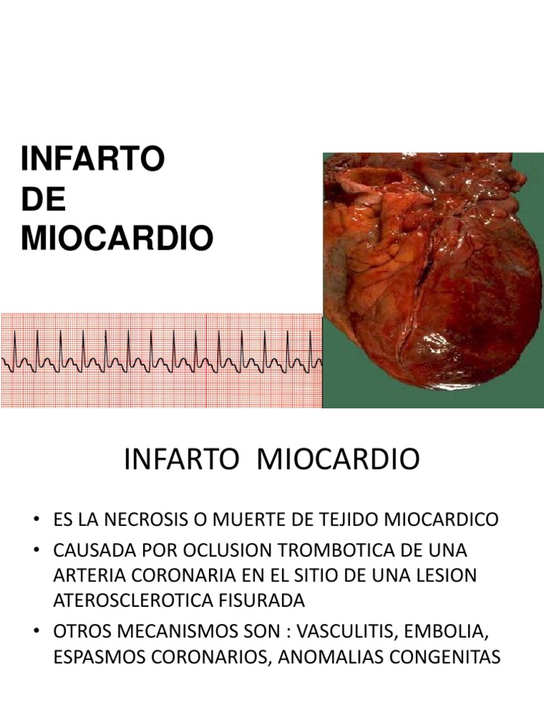 INFARTO TRANSMURAL | Sistema cardiovascular | Medicina CLINICA