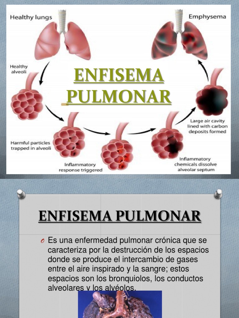 Tipos de enfisema pulmonar y tratamiento | PDF