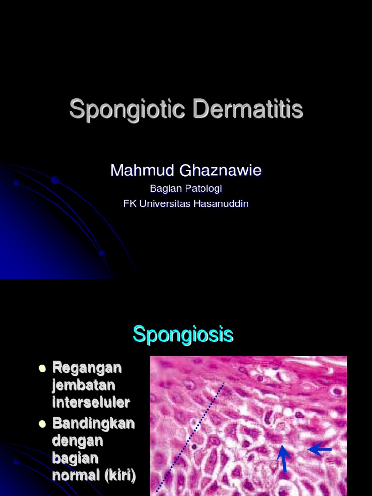 Spongiotic Dermatitis: Mahmud Ghaznawie | PDF