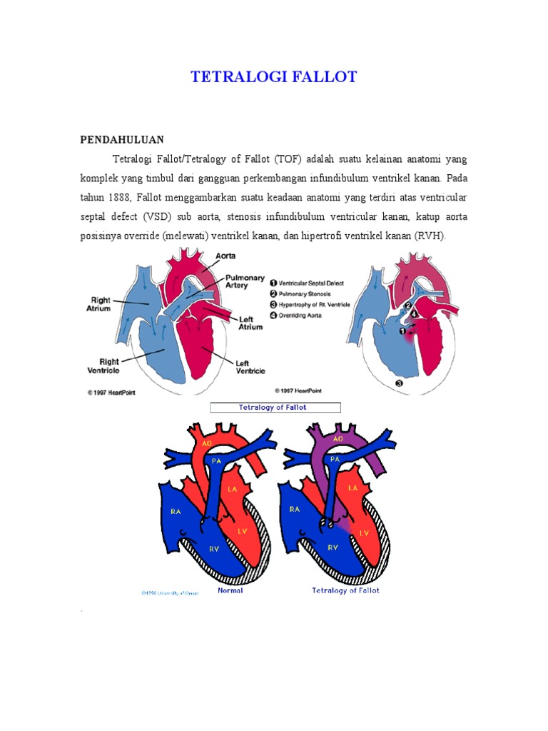 Tetralogy of Fallot | PDF
