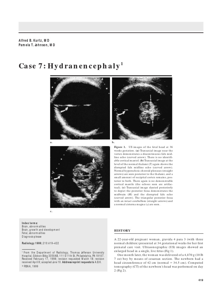 Case 7: Hydranencephaly: Alfred B. Kurtz, MD Pamela T. Johnson, MD | PDF