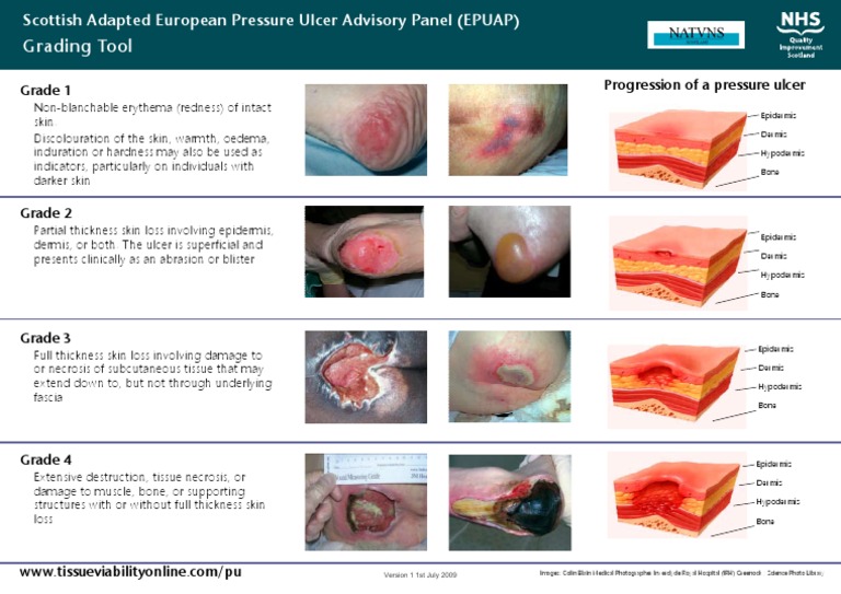 EPUAP Pressure Ulcer Grading Tool | PDF | Science & Mathematics