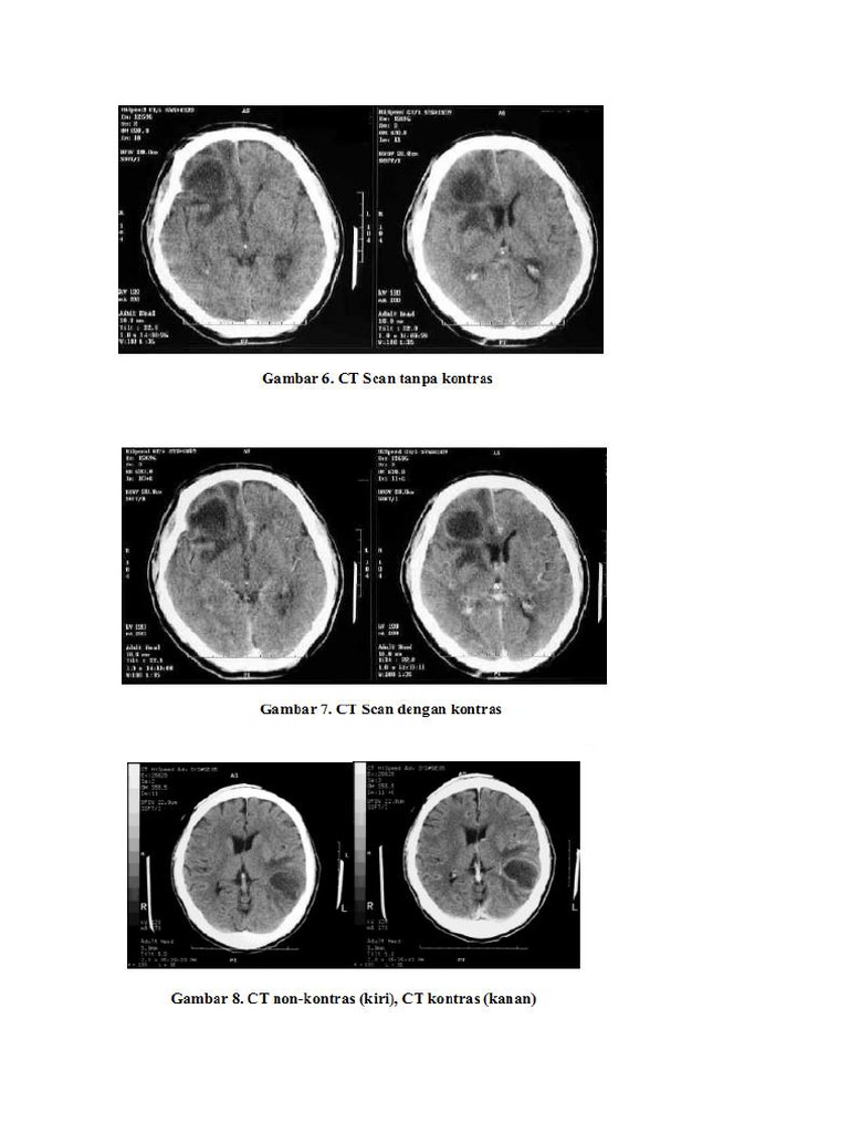 Abses Serebri | PDF | Tengkorak | Tumor Otak