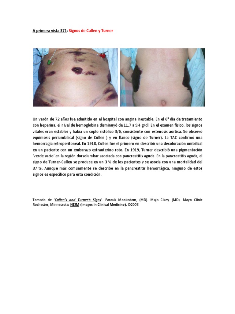 A Primera Vista 371 (Signos de Cullen y Turner) | PDF