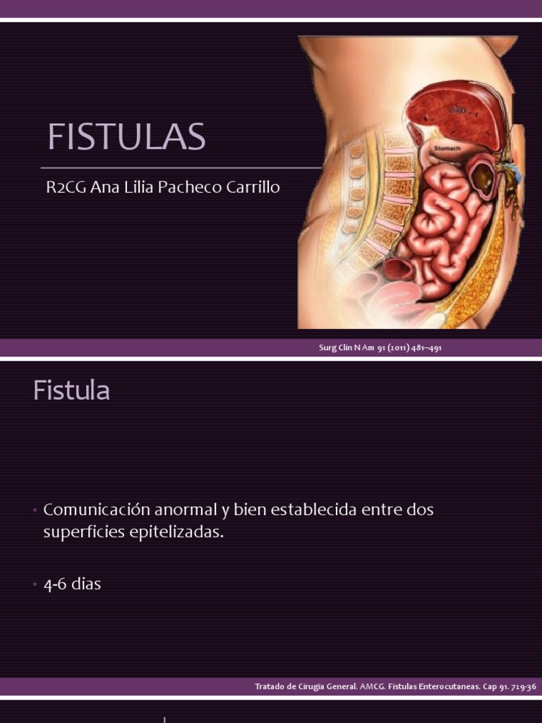 fistulas-130814211518-phpapp02 | Sistema digestivo humano | Páncreas ...
