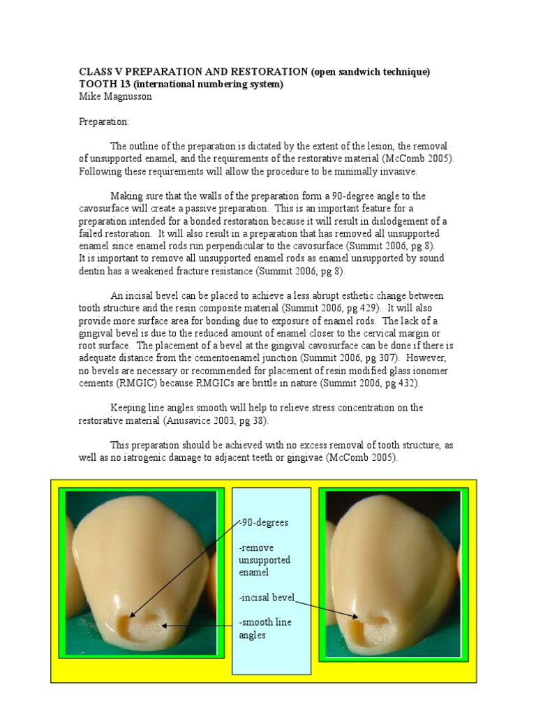 Class v Preparation and Restoration Open Sandwich Technique Enamel(1 ...