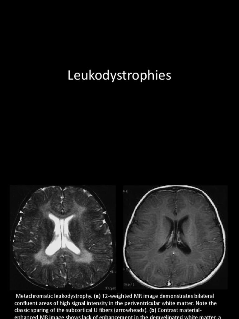 Leukodystrophies Imaging | PDF | White Matter | Magnetic Resonance Imaging