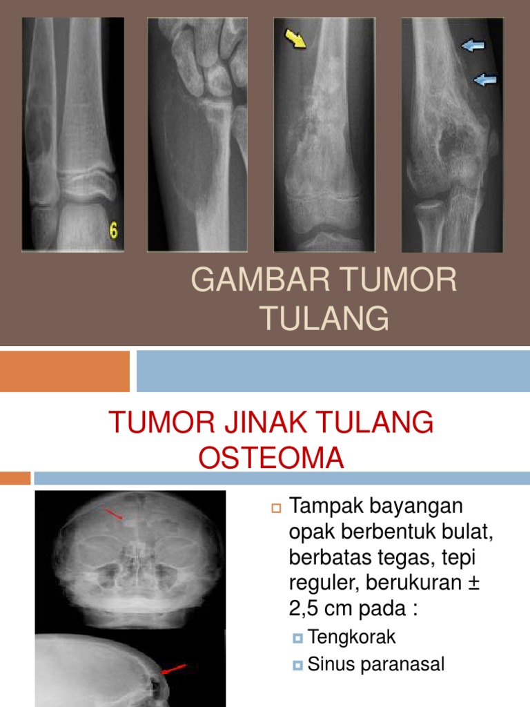 Radiologi Tumor Tulang | PDF