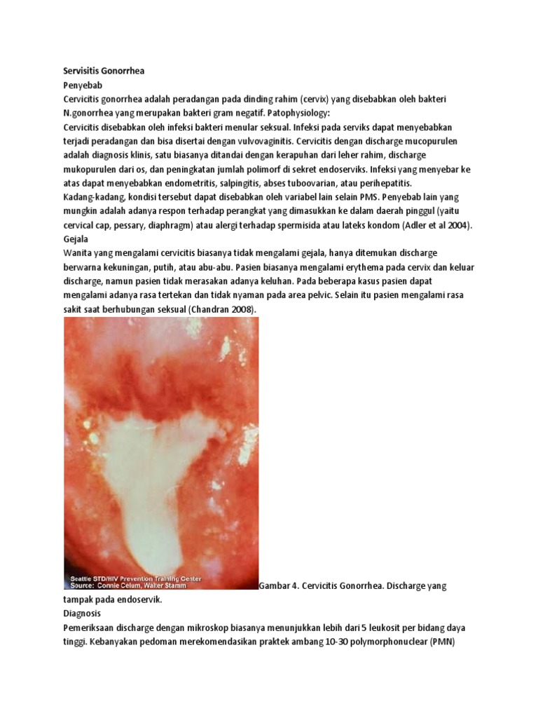 Servisitis Gonorrhea | PDF