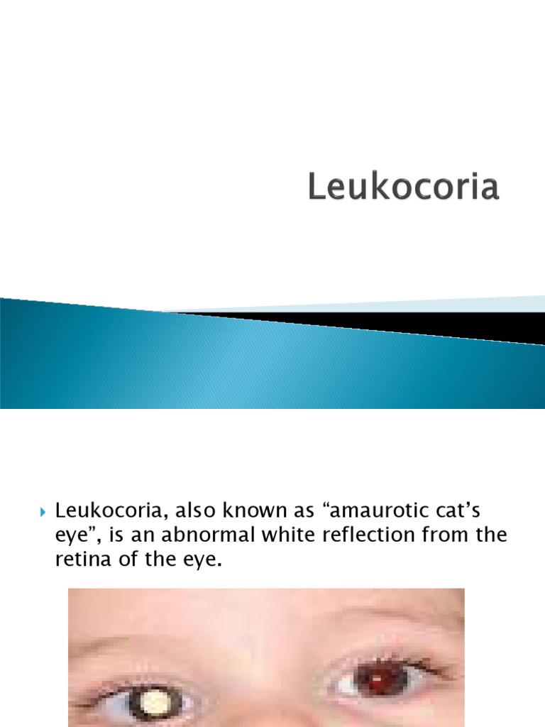 Leukocoria (2) | Human Eye | Cataract