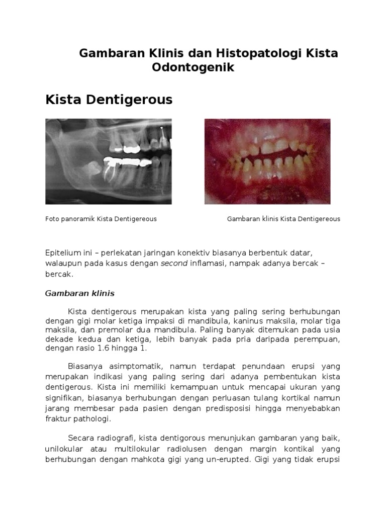 Gambaran Klinis Histopatologi Kista Odontogenik | PDF | Kajian Bahasa ...