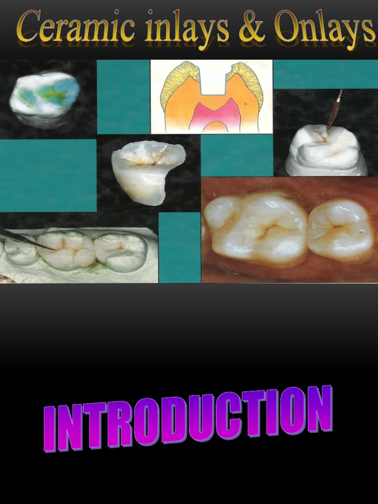Ceramic Inlays & Onlays | PDF | Dentistry | Mouth