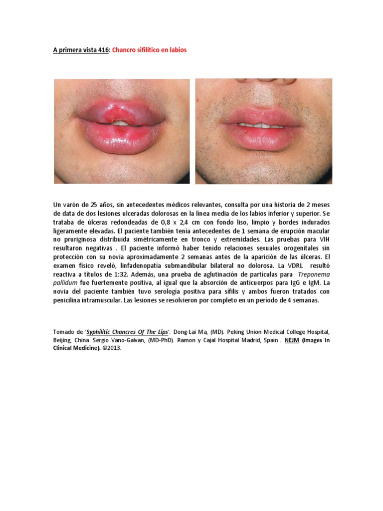 A Primera Vista 416 (Chancro Sifilítico en Labios) | PDF ...