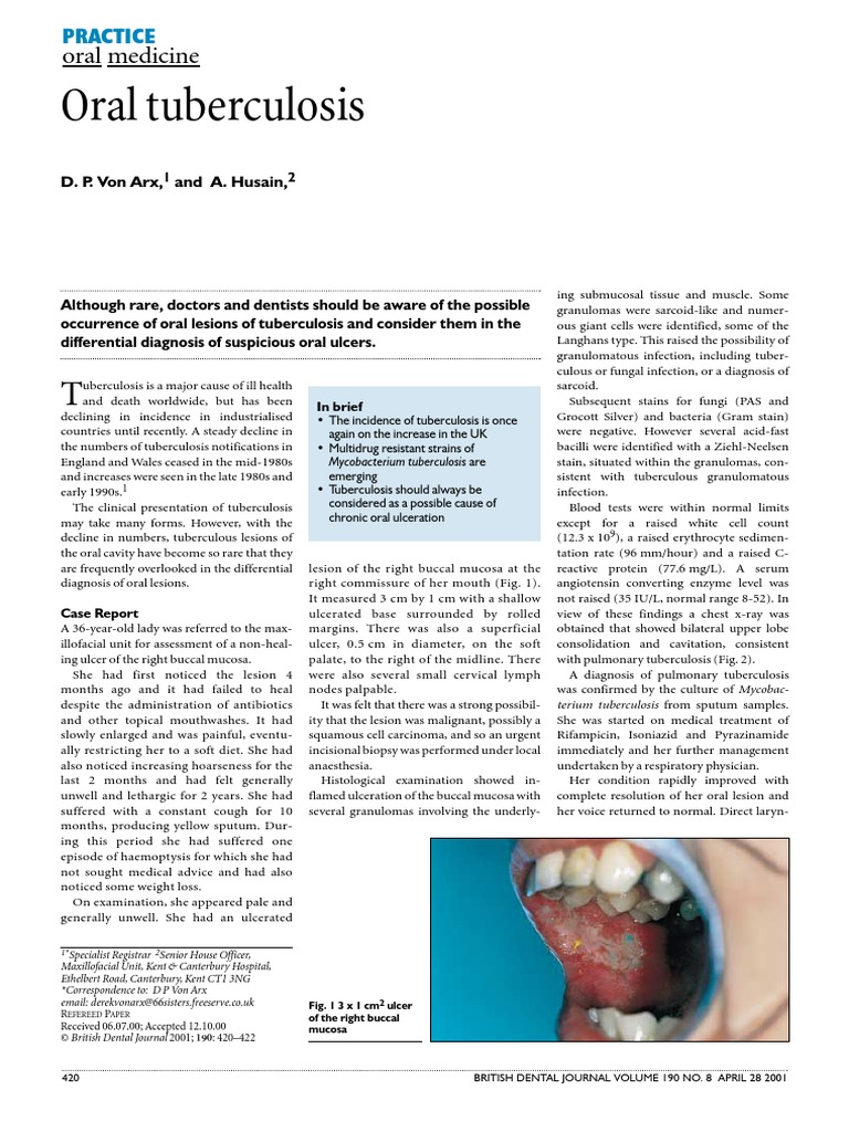 Oral Tuberculosis Oral Tuberculosis | British Dental Journal