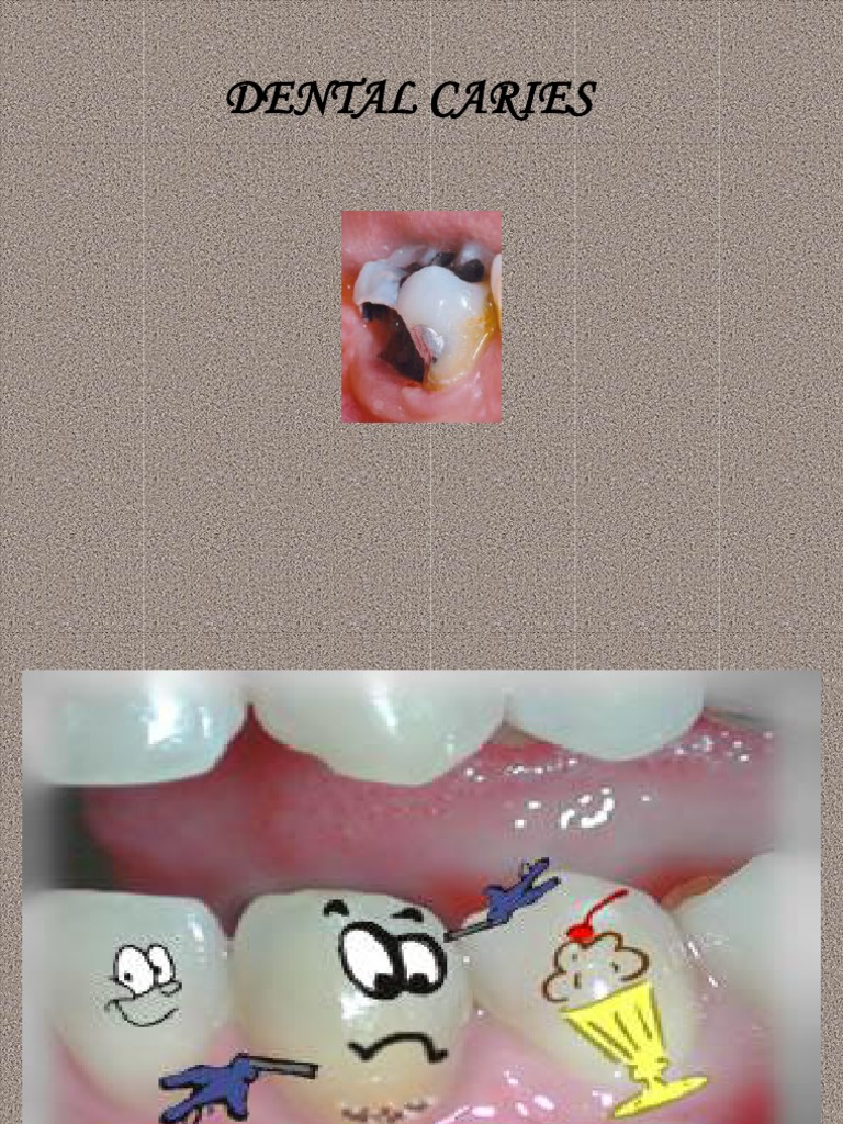 Dental Caries | Tooth Enamel | Dentin
