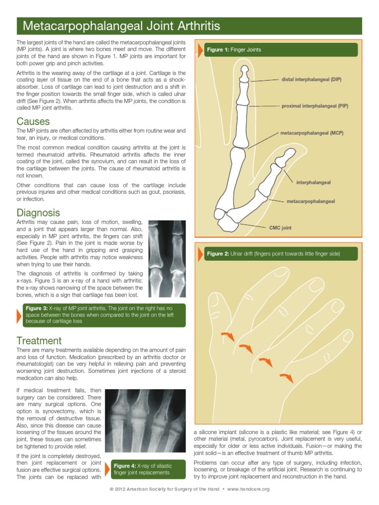 MP Joint | PDF | Arthritis | Joint