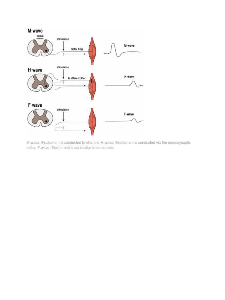 M-wave, H-wave and F-wave characteristics in nerve conduction studies ...