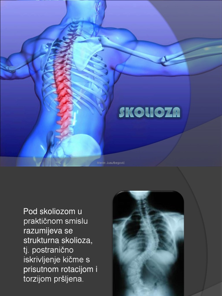 SKOLIOZA