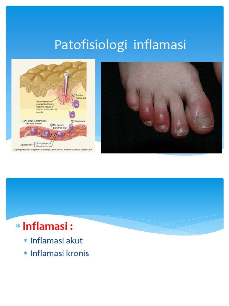 Patofisiologi inflamasi