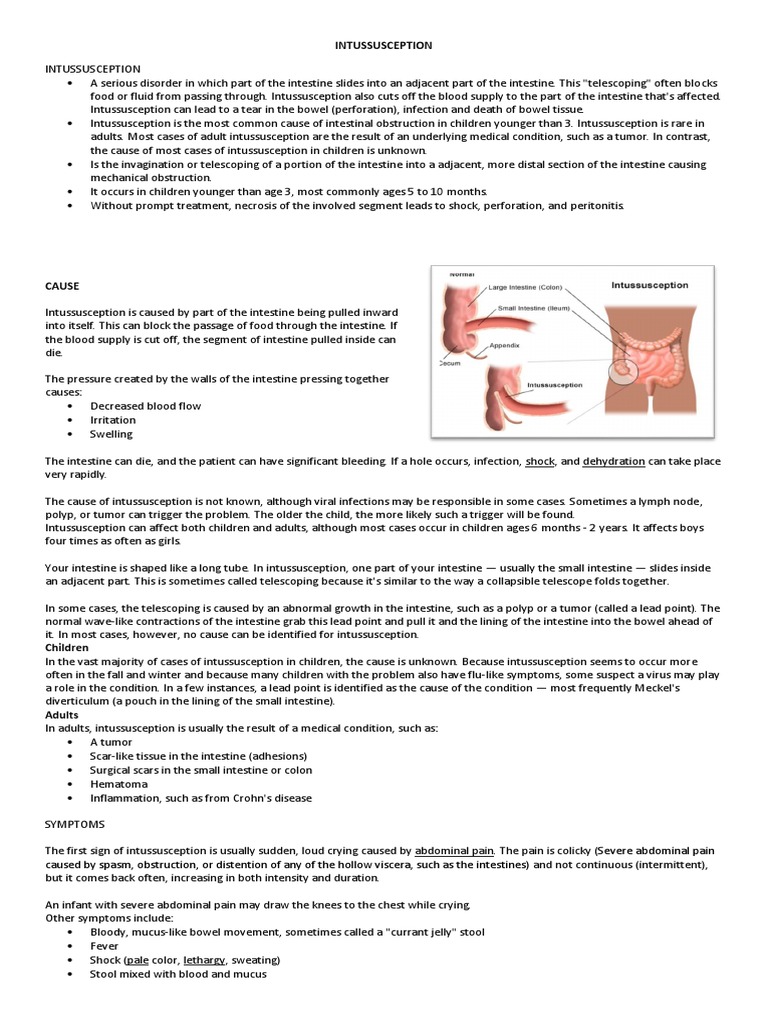 Intussusception | Medicine | Clinical Medicine