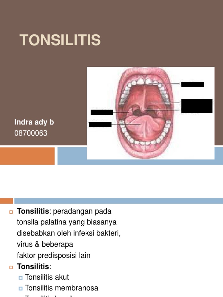 THT Tonsilitis | PDF