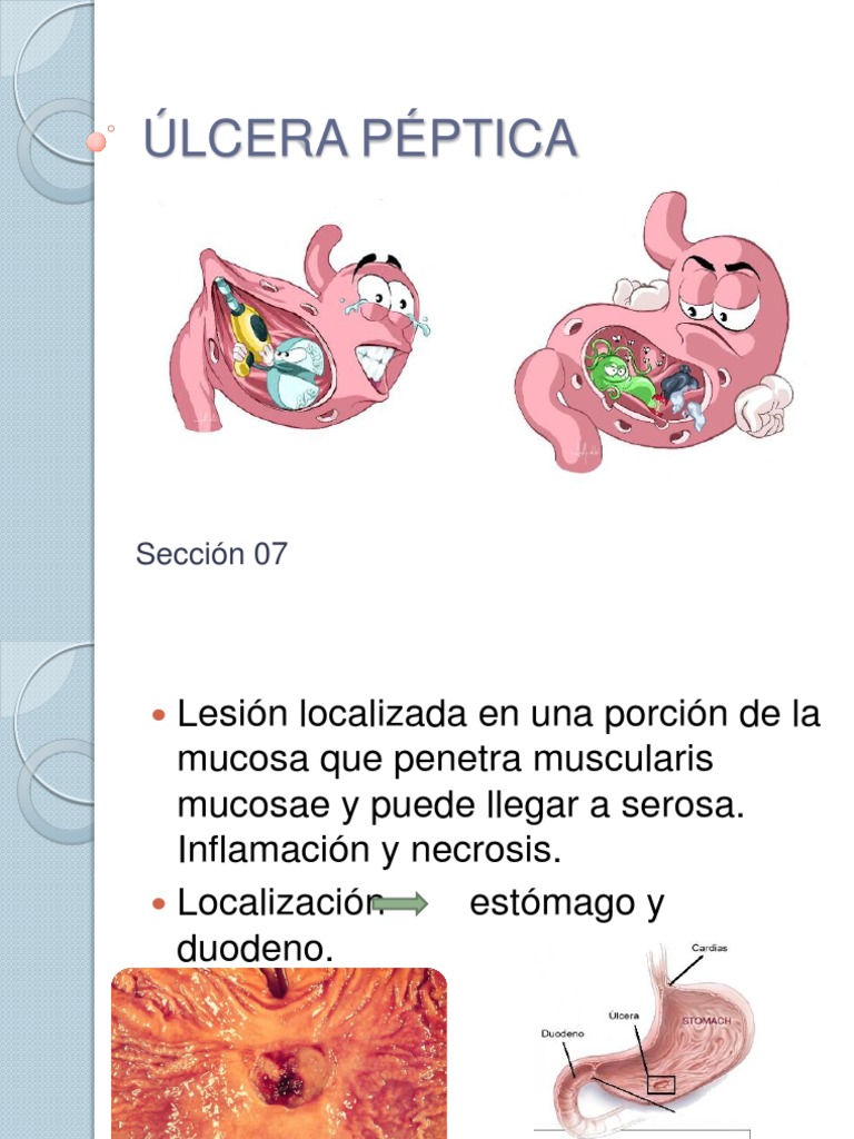 Úlcera Péptica | Úlcera péptica | Gastroenterología
