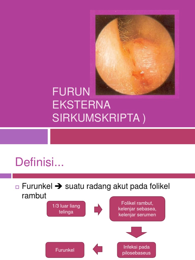 Furunkel (Otitis Eksterna Sirkumskripta) | PDF