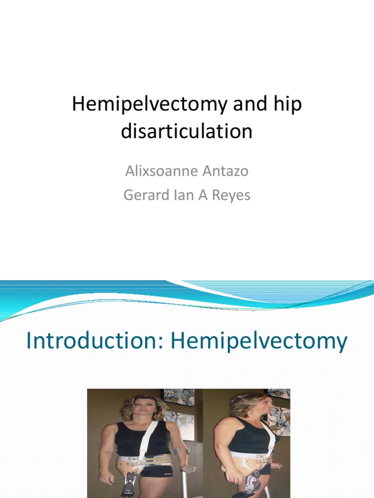 Hemipelvectomy and Hip Disarticulation | PDF | Pelvis | Hip