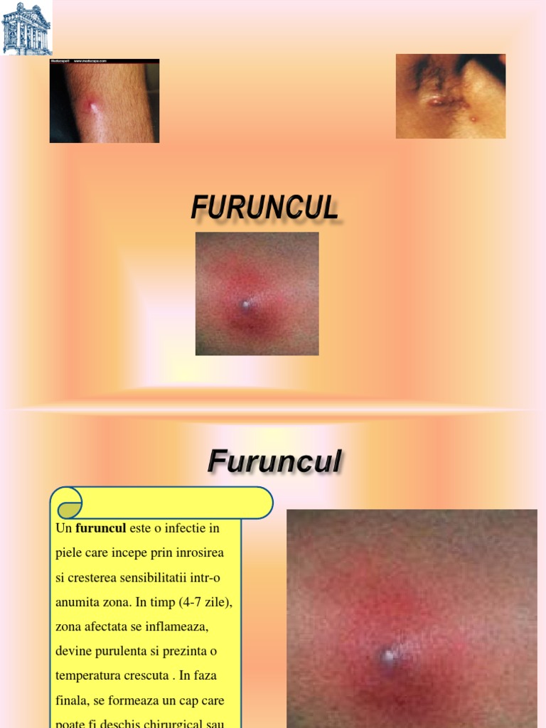 Furuncul | PDF