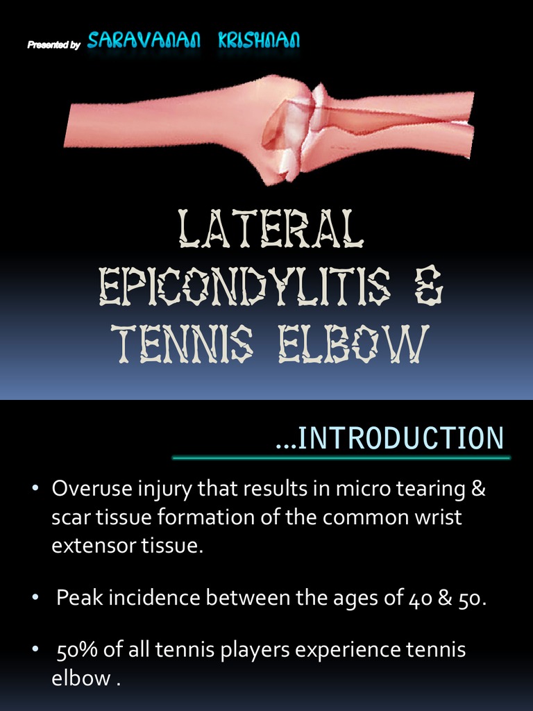 Lateral Epicondylitis Overview | PDF | Elbow | Hand