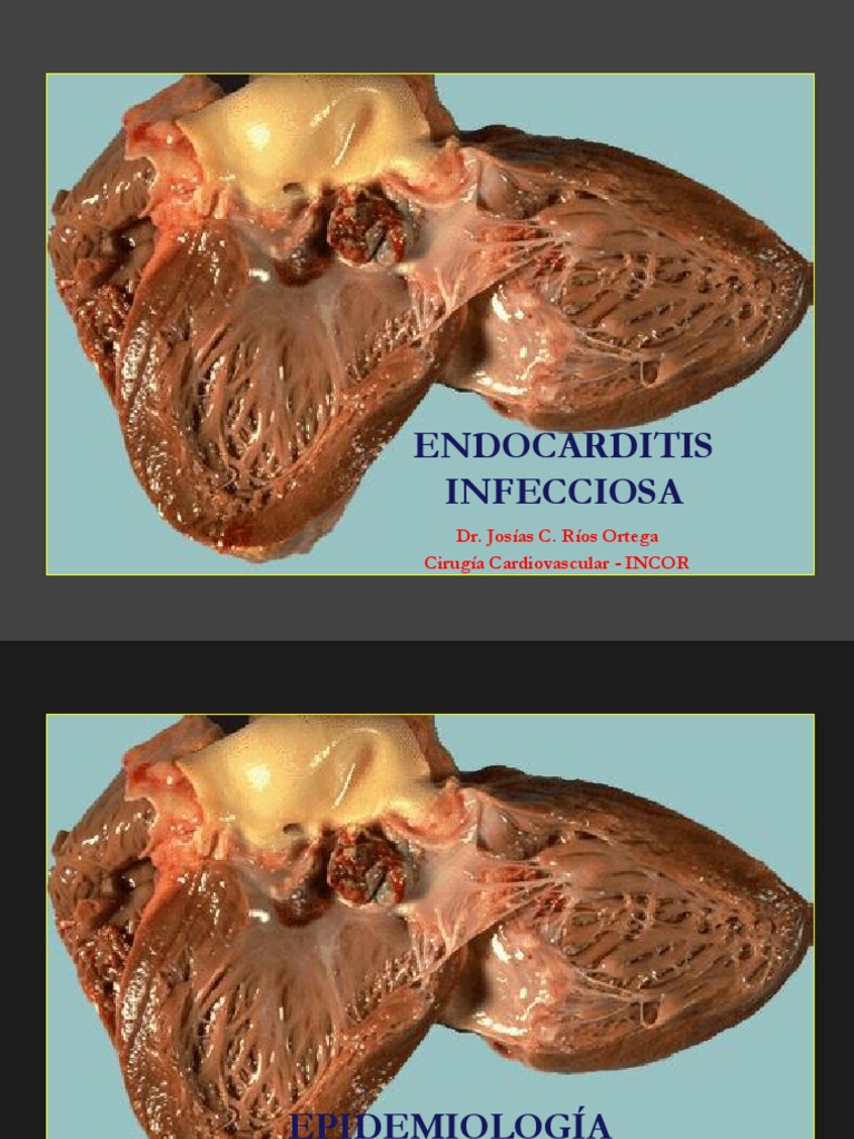 Endocarditis infecciosa - Dr. Josías Ríos Ortega