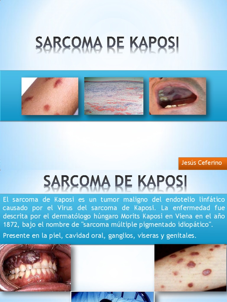 Sarcoma de Kaposi | PDF | Sarcoma | VIH / SIDA