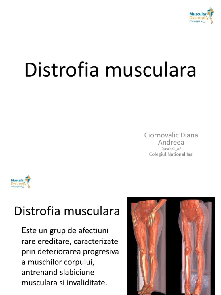 Distrofia Musculara | PDF