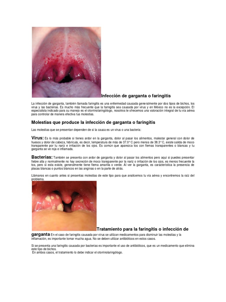 Infección de Garganta o Faringitis | PDF | Virus | Infección