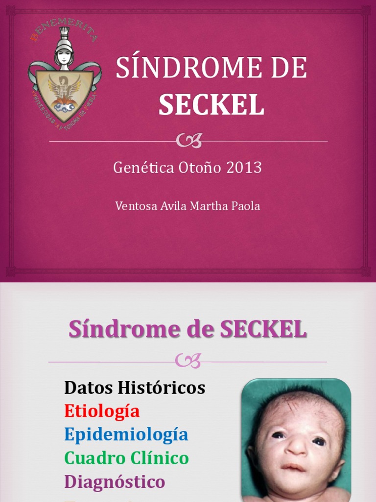 Síndrome de Seckel | PDF | Genética | Enfermedades y trastornos
