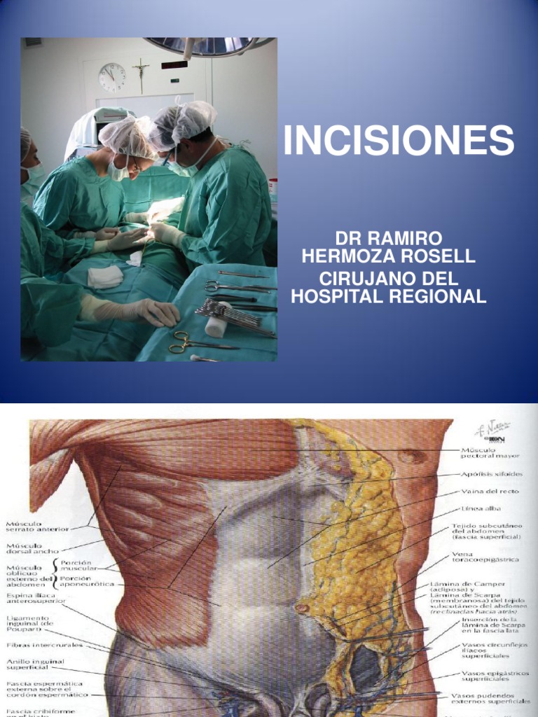 INCISIONES.ppt