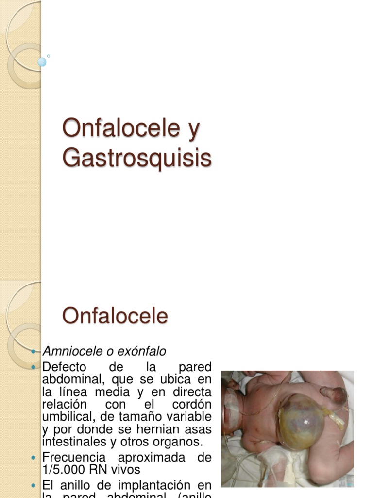 Onfalocele y Gastrosquisis | Abdomen | Ciencias de la Salud