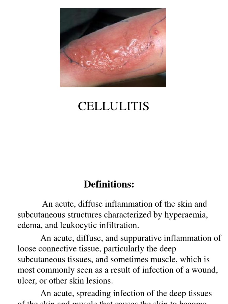 Cellulitis | PDF | Methicillin Resistant Staphylococcus Aureus ...