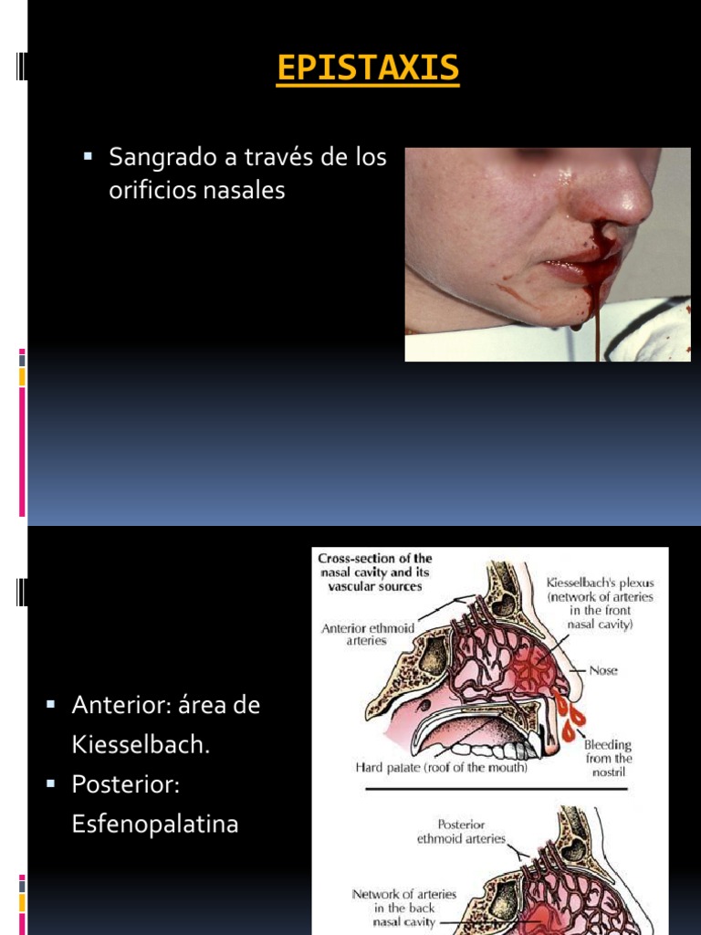 Epistaxis | PDF | Especialidades Medicas | Medicina