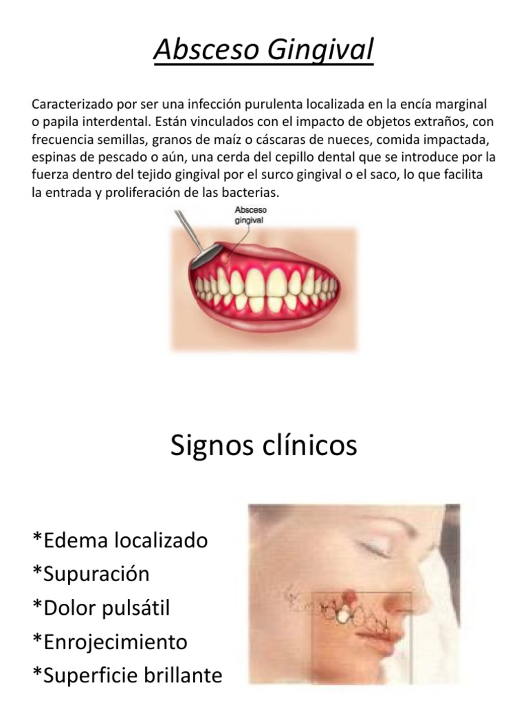 Absceso Gingival | PDF