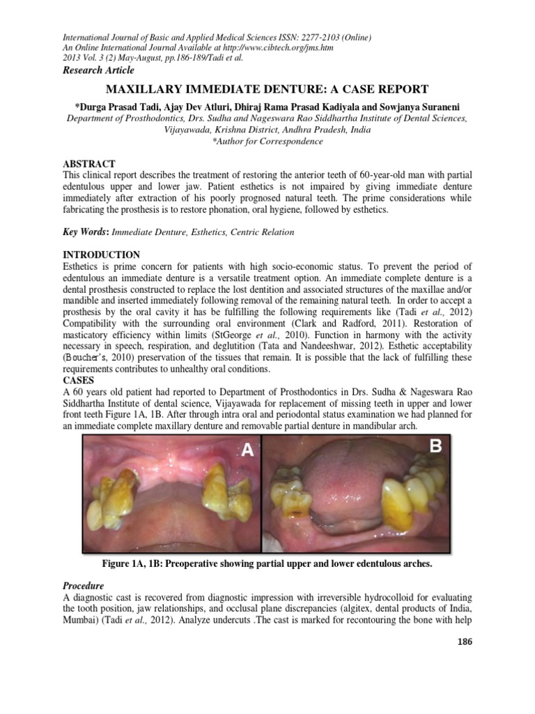 Maxillary Immediate Denture A Case Report | PDF | Dentures | Dentistry