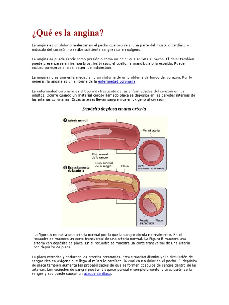 Qué Es La Angina | PDF | Angina de pecho | Infarto de miocardio