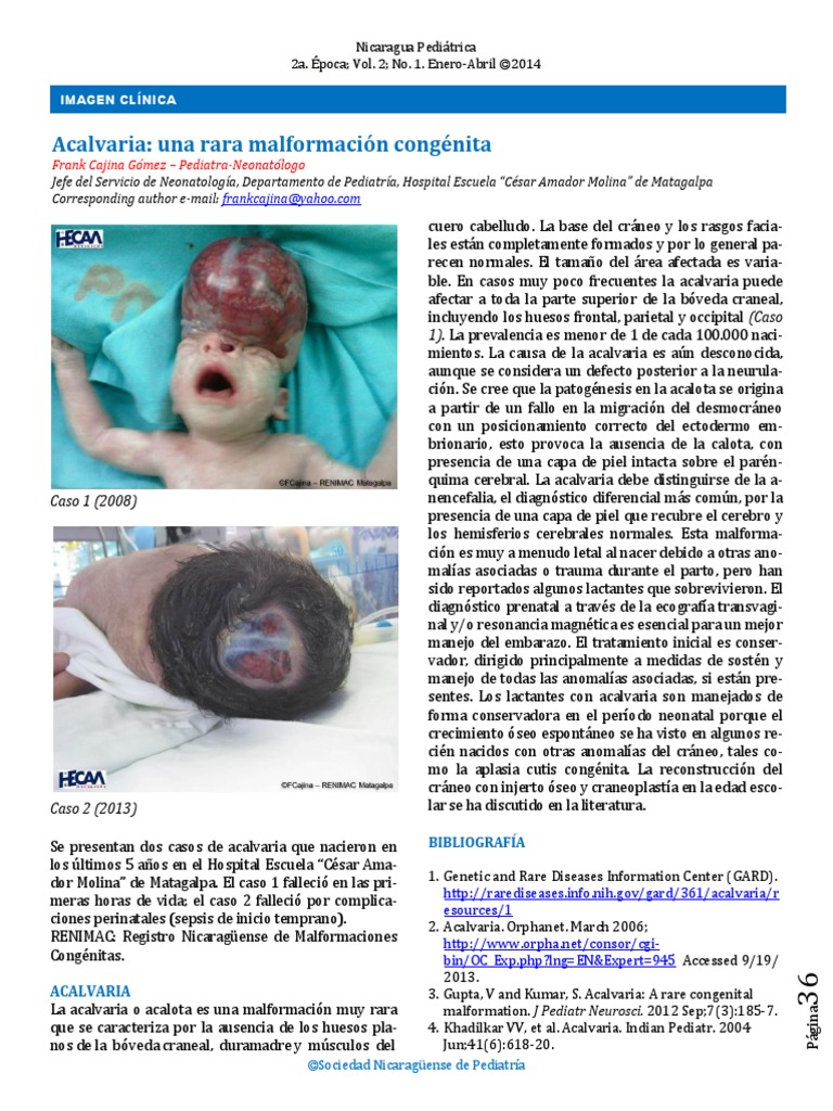 Acalvaria: Una Rara Malformación Congénita | PDF | Cráneo ...