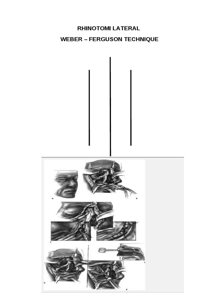 Weber - Ferguson Technique | PDF | Primate Anatomy | Skeletal System